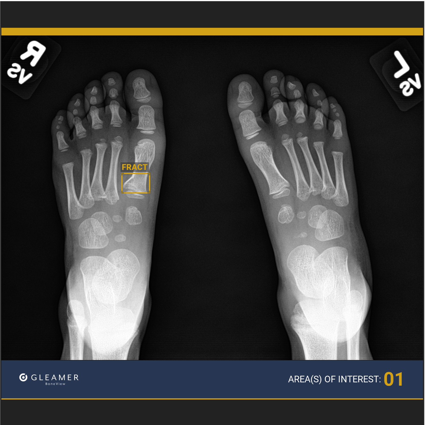 Gleamer BoneView Reviews, Pricing, Features & Integrations | Elion