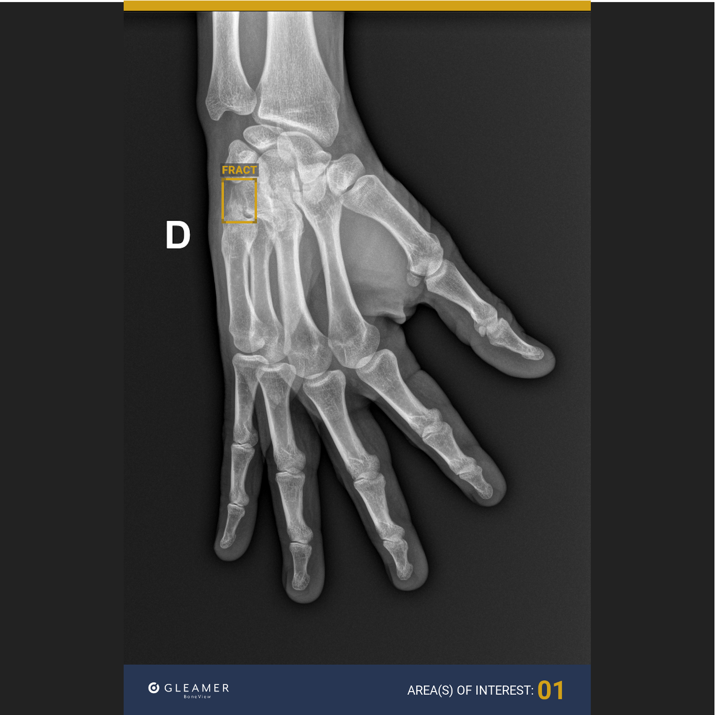 Gleamer BoneView Reviews, Pricing, Features & Integrations | Elion